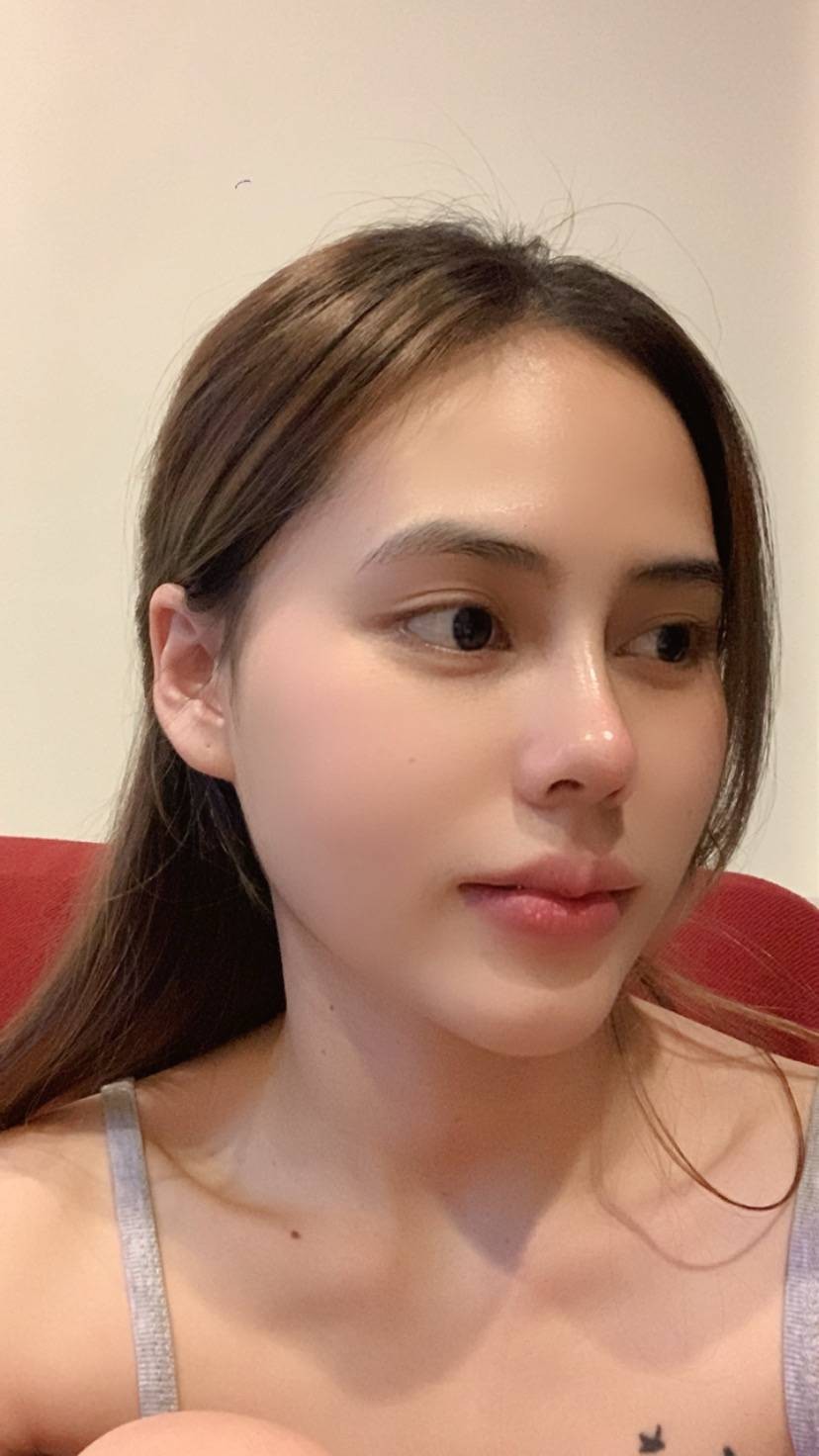 รีวิว DSC CLINIC สาขาบางแสน บางแสน - เสริมจมูกครั้งแรกในชีวิต 💕