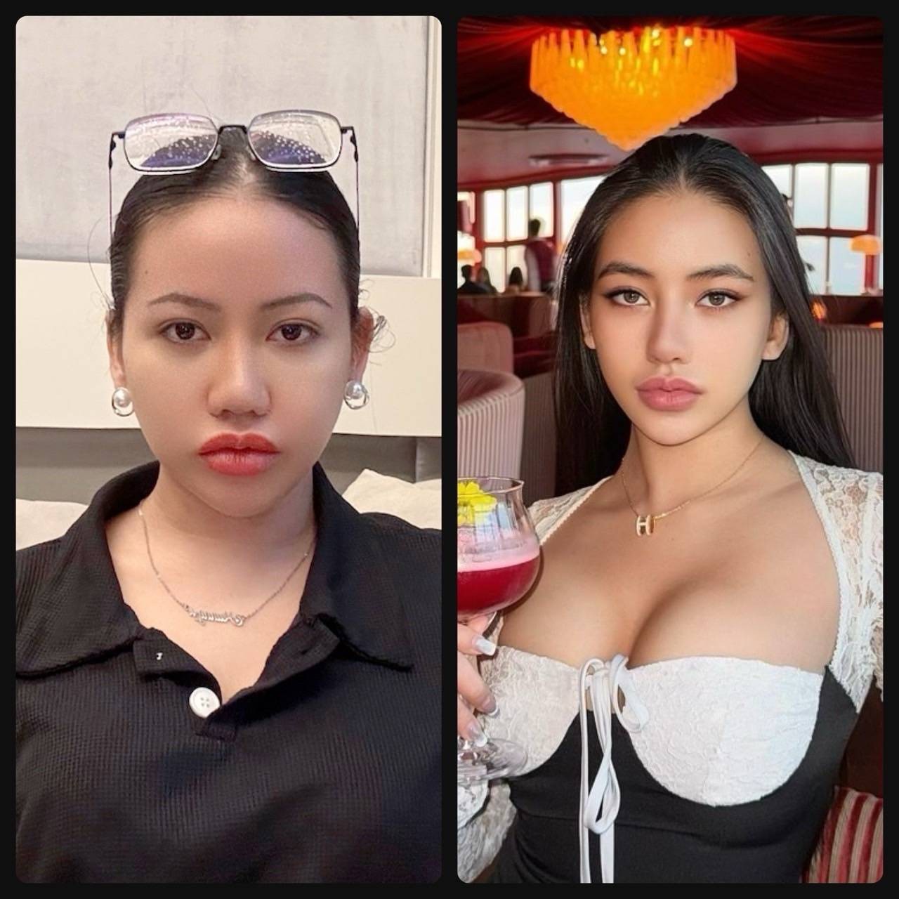 รีวิว S45 Clinic กรุงเทพ - แก้จมูกซี่โครง หมอบิ๊ก 1 เดือน