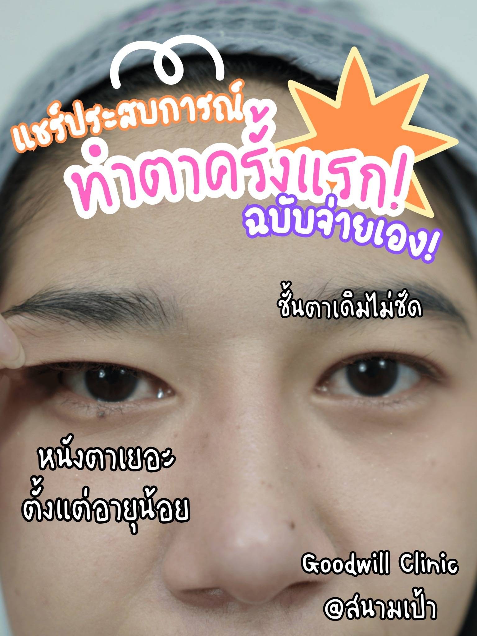รีวิว Goodwill Clinic สนามเป้า - พอใจมากค่า ตาสวยมาก💕🥹