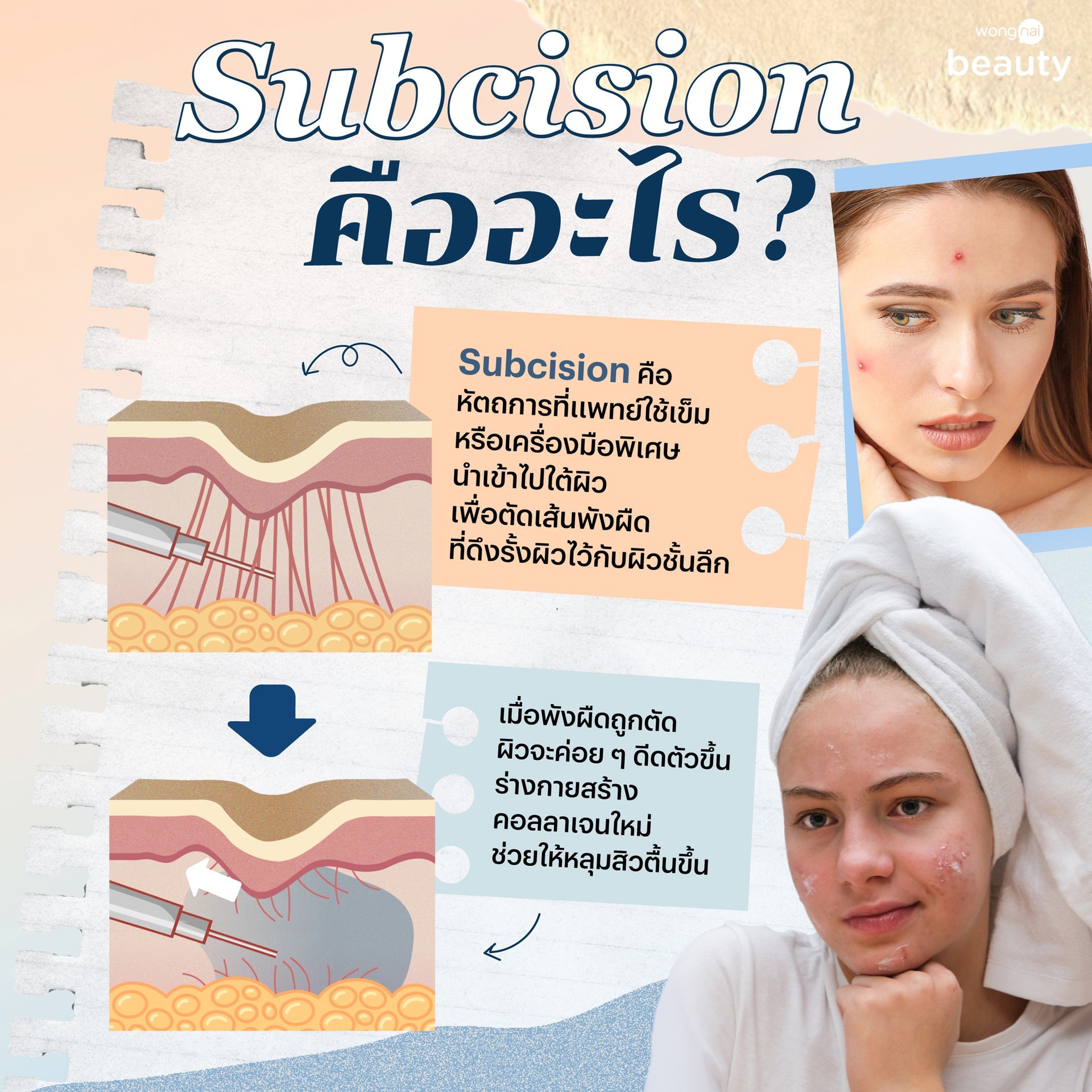 รู้จักการทำ Subcision รักษาหลุมสิว ทางลัดของคนอยากมีผิวหน้าเรียบเนียน
