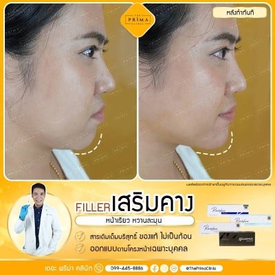 ฟิลเลอร์ • หลังฉีดฟิลเลอร์คางทันที ร้าน The Prima Clinic Si Racha เดอะ ...